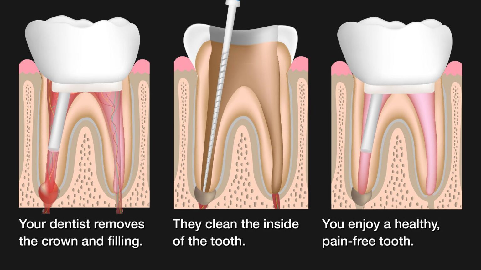 Affordable Root Canal and Crown Costs in Los Angeles: Dental Savings ...